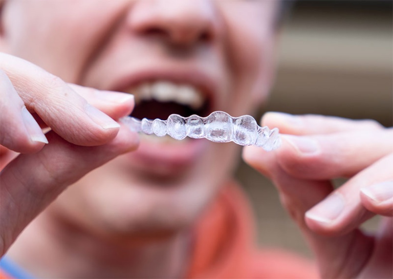 What You Should Know About Invisalign | Orange, CA | Dr Christoper J ...